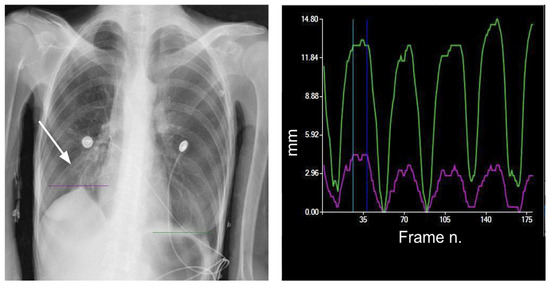Portable Dynamic Chest Radiography: Literature Review and Potential ...