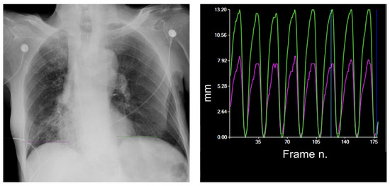 Portable Dynamic Chest Radiography: Literature Review and Potential ...