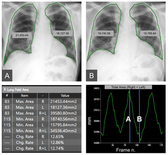 Portable Dynamic Chest Radiography: Literature Review and Potential ...