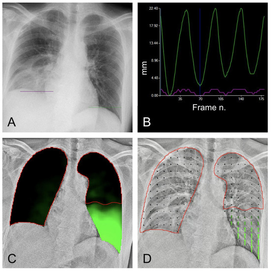 Portable Dynamic Chest Radiography: Literature Review and Potential ...