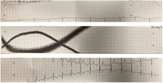 Exploring Brain and Heart Interactions during Electroconvulsive Therapy ...