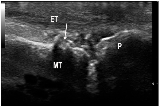 Medical Sciences | Free Full-Text | Ultrasound Features in Gout: An ...