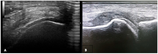 Medical Sciences | Free Full-Text | Ultrasound Features in Gout: An ...