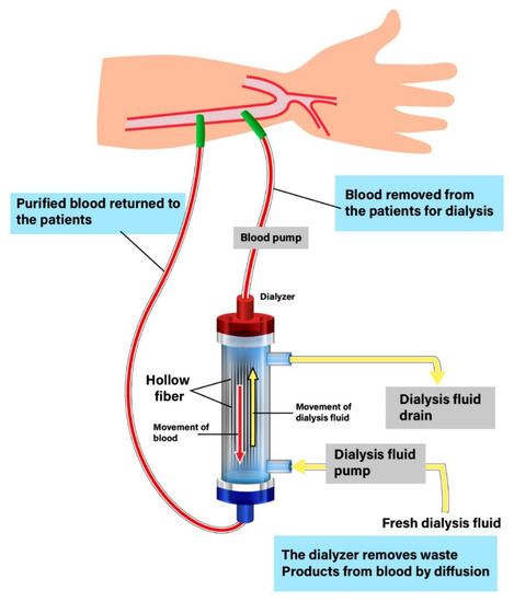 Membranes | Free Full-Text | Influence of Dialysis Membranes on ...