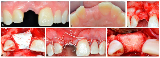 The Use of Biocompatible Membranes in Oral Surgery: The Past, Present ...