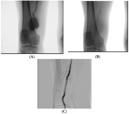 Expanded Polytetrafluoroethylene Membranes for Vascular Stent Coating ...