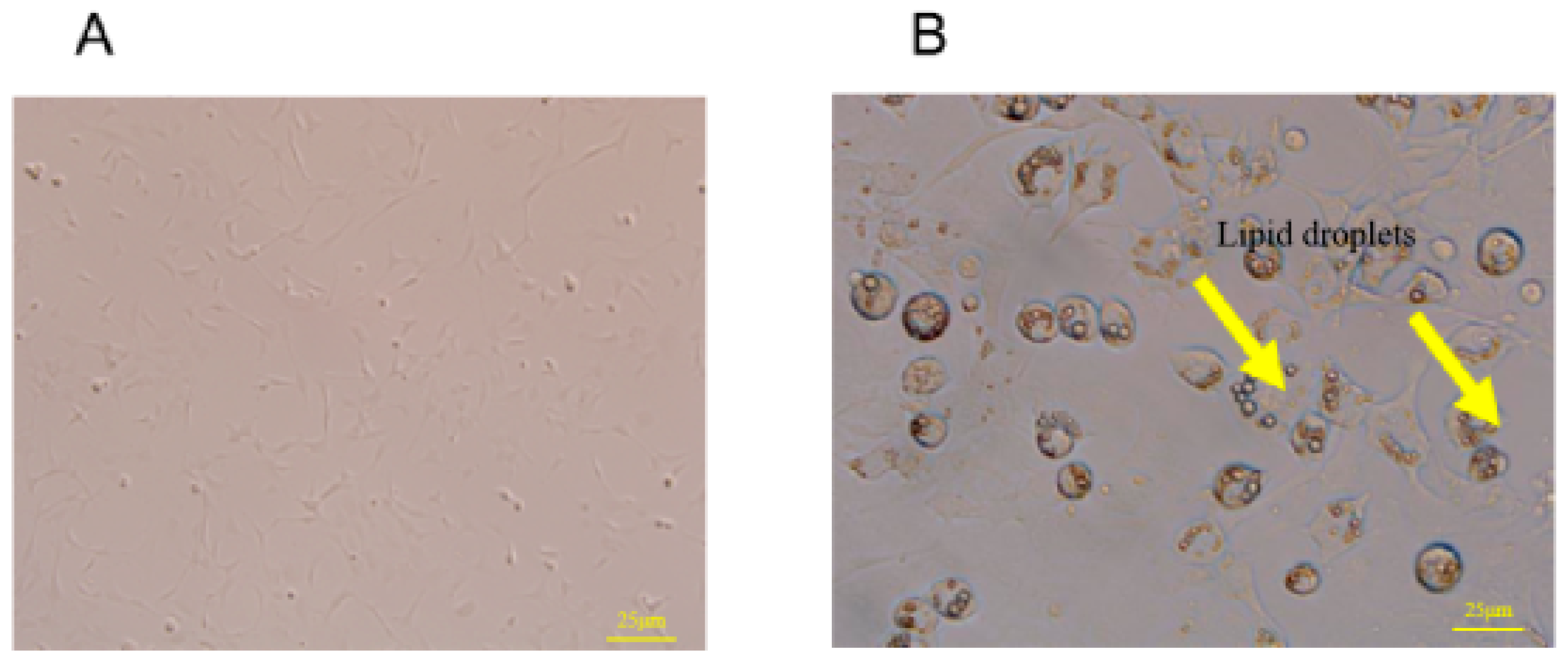 Fat Droplets In Urine