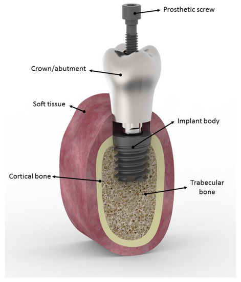 Fatigue Design of Dental Implant Assemblies: A Nominal Stress Approach