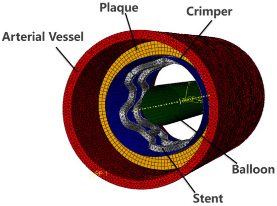 Finite Element Analysis of Fluid–Structure Interaction in a Model of an L-Type Mg Alloy Stent ...