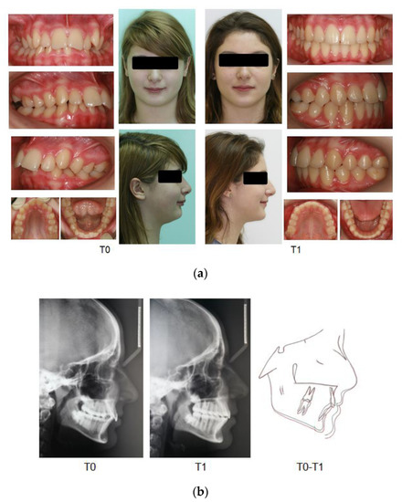 The Use of Selective Laser Melting in Mandibular Retrognathia Correction