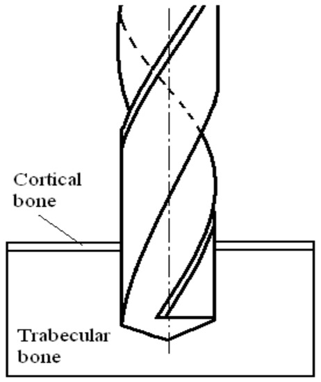 A Review of Surgical Bone Drilling and Drill Bit Heat Generation for ...