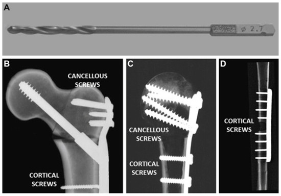 A Review of Surgical Bone Drilling and Drill Bit Heat Generation for ...