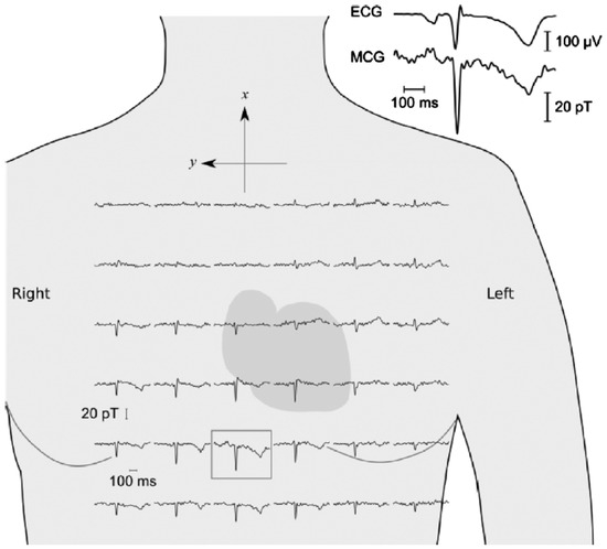 Magnetic Micro and Nano Sensors for Continuous Health Monitoring
