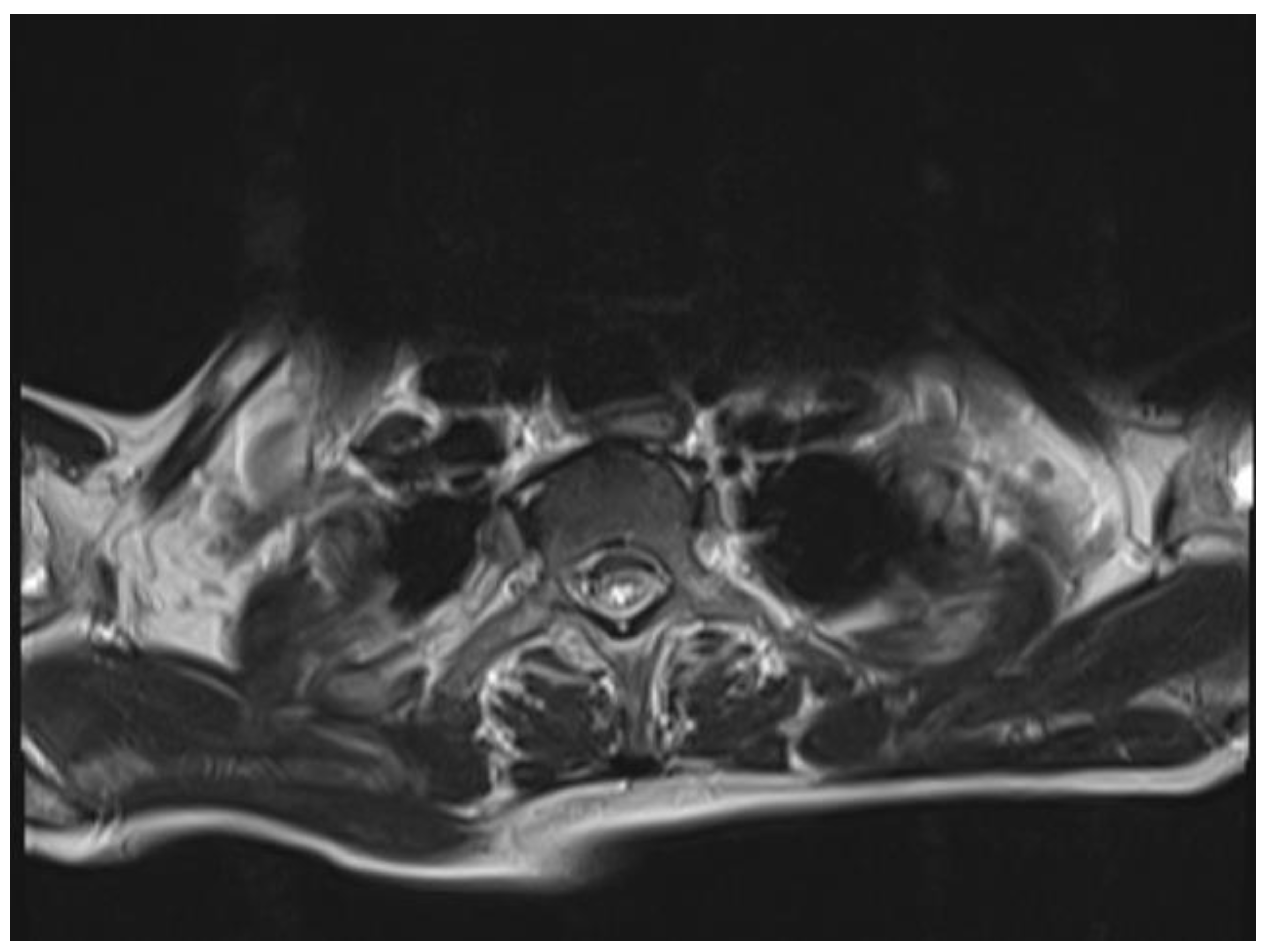 Longitudinally Extensive Transverse Myelitis Associated with ...