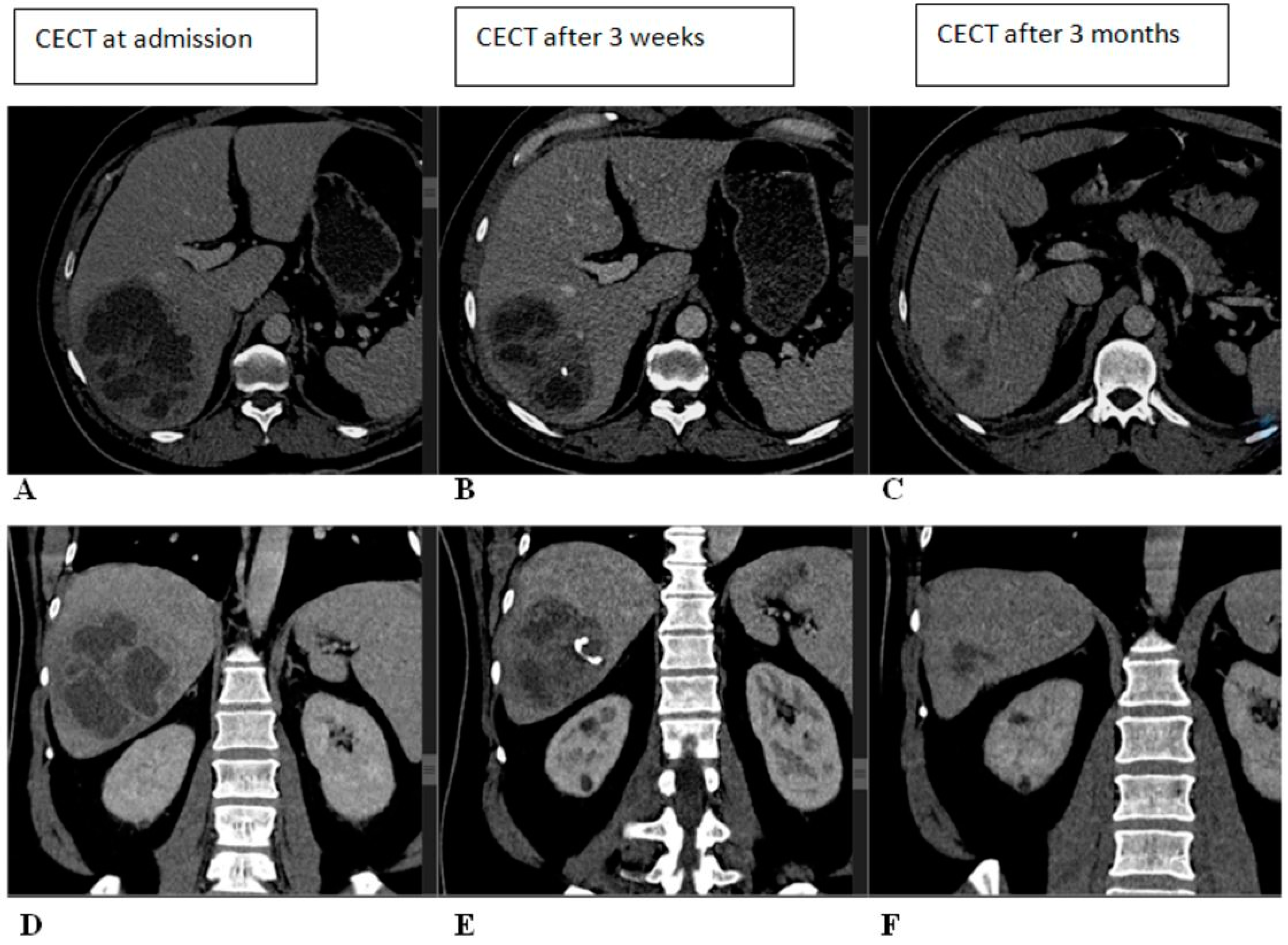 Severe Localized Q Fever, a Diagnostic Challenge: Report of Two Cases ...