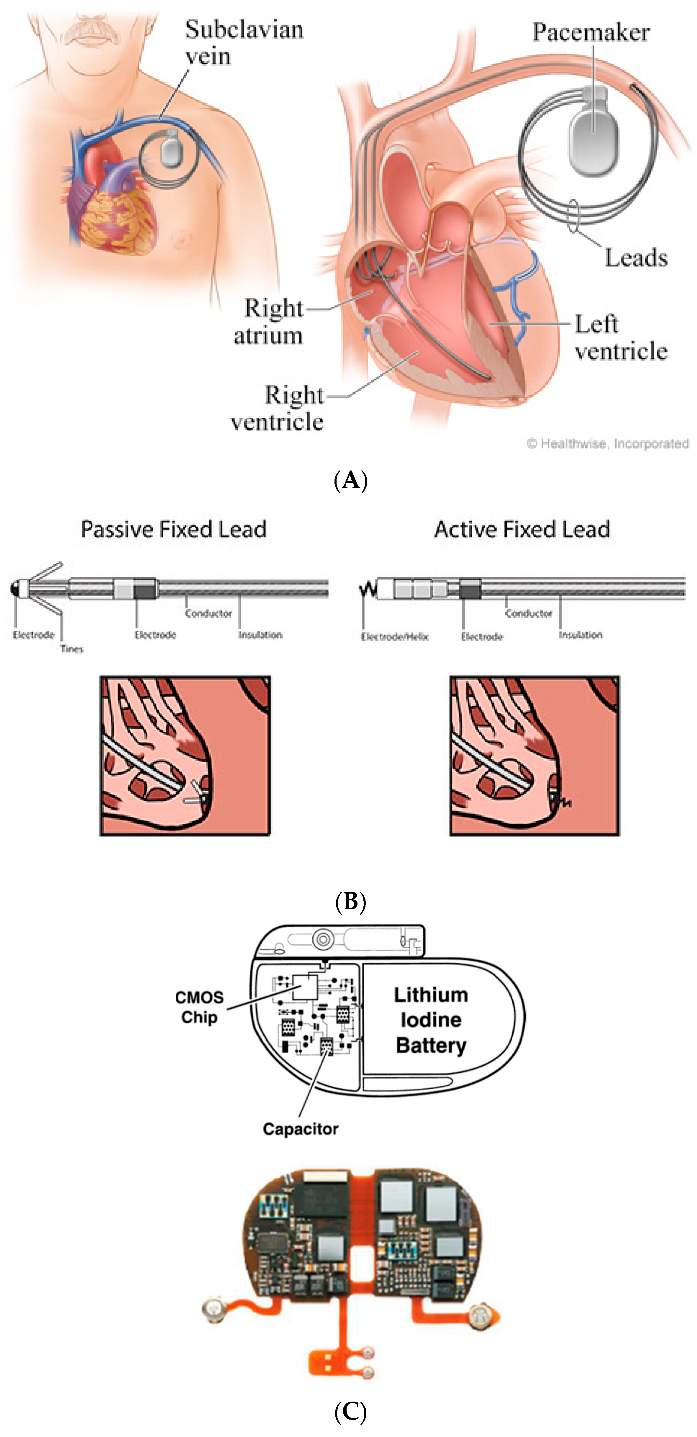 Implantable Cardioverter Defibrillator Vs Pacemaker