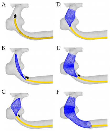 Structural Design of Vascular Stents: A Review