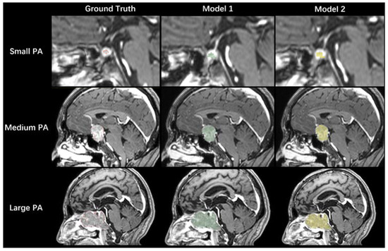 Three-Dimensional Semantic Segmentation of Pituitary Adenomas Based on the Deep Learning ...