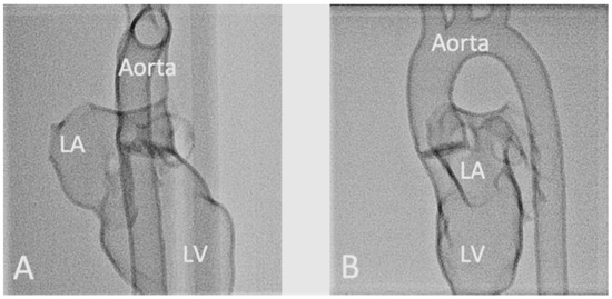 3D Printed Models in Cardiovascular Disease: An Exciting Future to ...