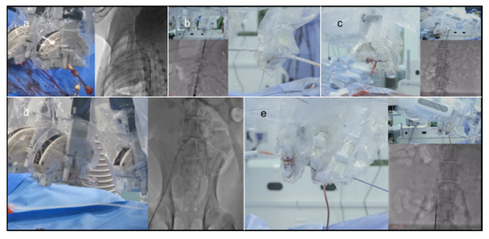 Novel Endovascular Interventional Surgical Robotic System Based on ...