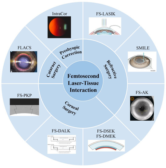 Micromachines | Free Full-Text | Femtosecond Laser-Assisted Ophthalmic Surgery: From Laser ...