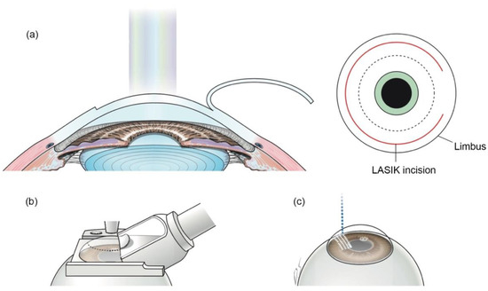 Femtosecond Laser-Assisted Ophthalmic Surgery: From Laser Fundamentals ...