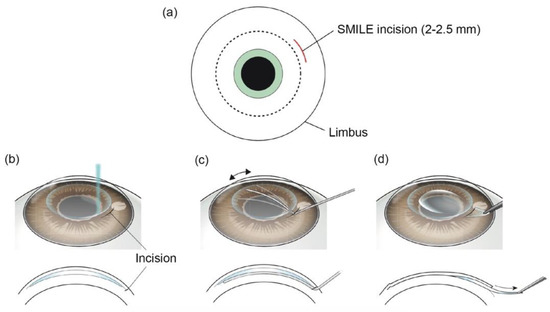 Micromachines | Free Full-Text | Femtosecond Laser-Assisted Ophthalmic ...