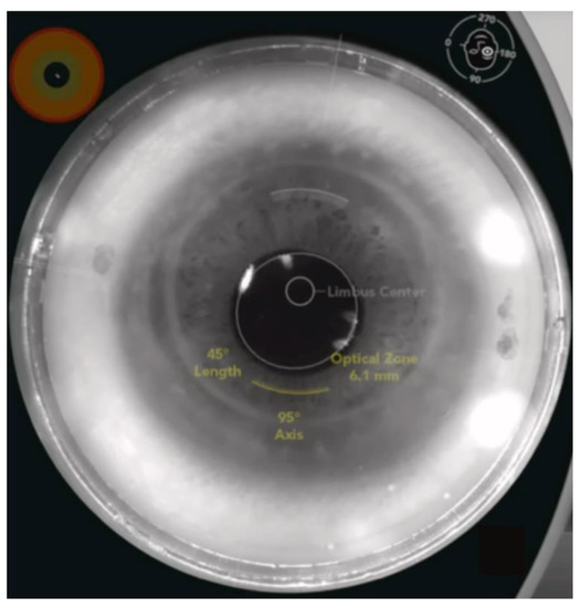 Femtosecond Laser-Assisted Ophthalmic Surgery: From Laser Fundamentals ...
