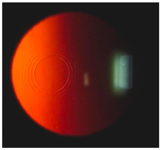 Femtosecond Laser-Assisted Ophthalmic Surgery: From Laser Fundamentals ...