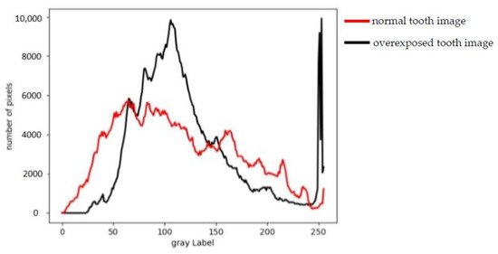 Dental Lesion Segmentation Using an Improved ICNet Network with Attention
