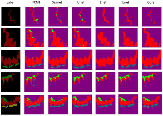 Dental Lesion Segmentation Using an Improved ICNet Network with Attention