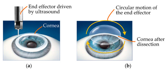 Design and Experiment of an Ultrasound-Assisted Corneal Trephination System