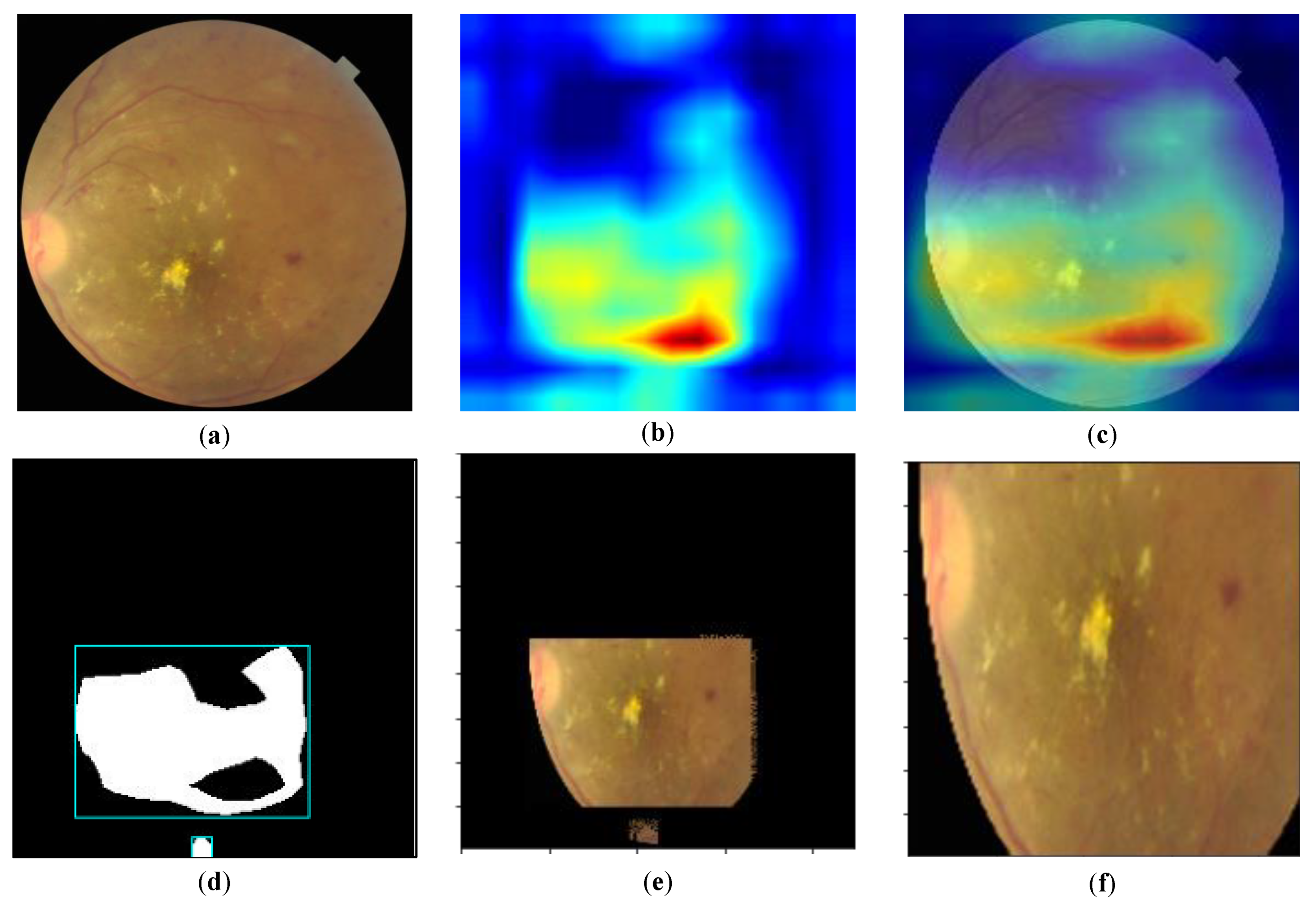 A Multi-Label Detection Deep Learning Model with Attention-Guided Image Enhancement for Retinal ...