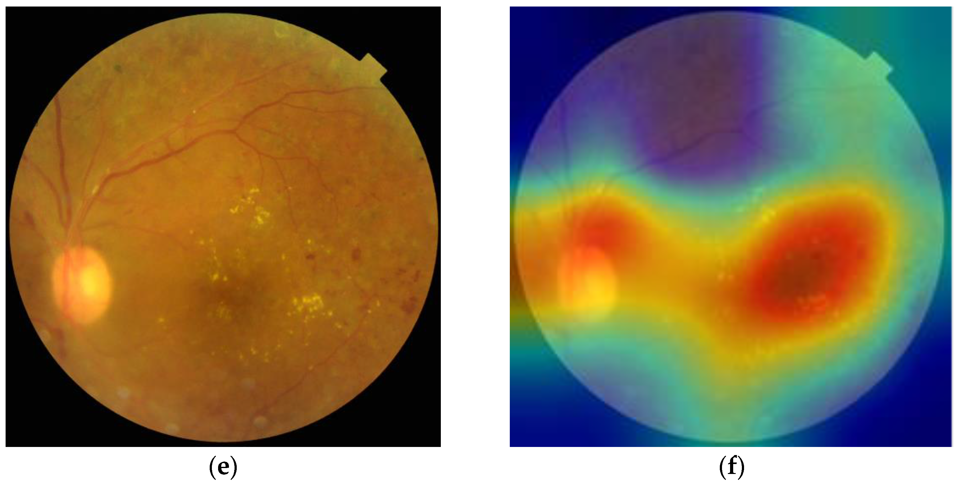 A Multi-Label Detection Deep Learning Model with Attention-Guided Image Enhancement for Retinal ...