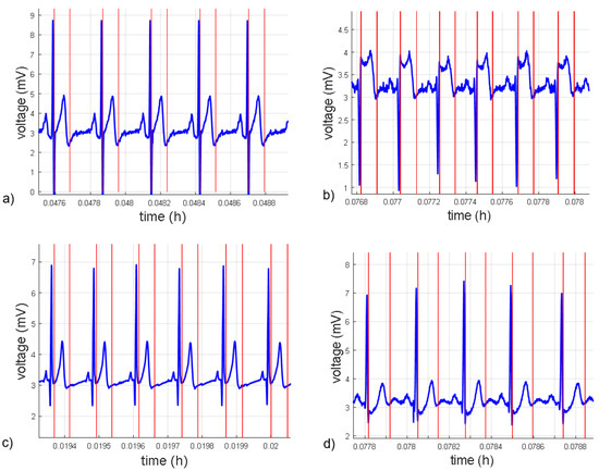 Implementation of Wavelet-Transform-Based Algorithms in an FPGA for Heart Rate and RT Interval ...