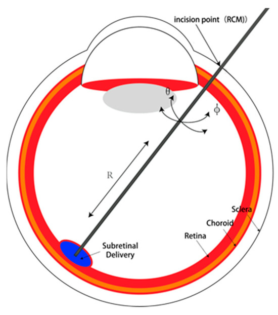 Design of a Subretinal Injection Robot Based on the RCM Mechanism