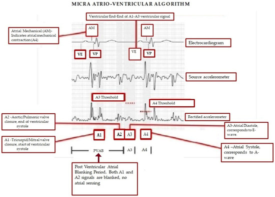 Leadless Pacing: Current Status and Ongoing Developments