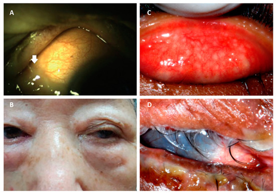 A Pyrrhic Victory: The PMN Response to Ocular Bacterial Infections