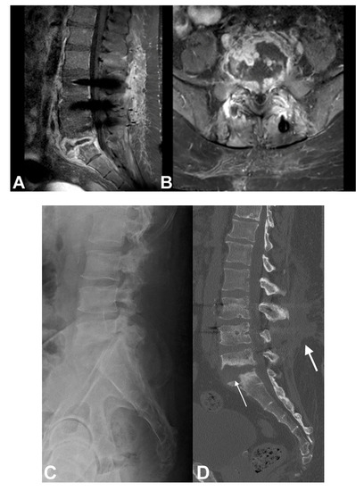 Microorganisms | Free Full-Text | Spinal Infections: An Update