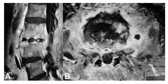 Microorganisms | Free Full-Text | Spinal Infections: An Update