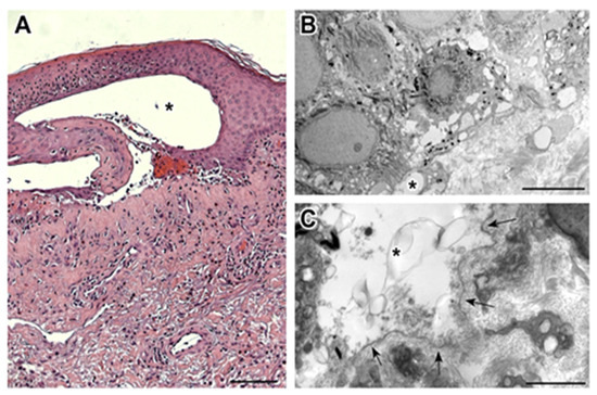 May Bacterial Infections Trigger Bullous Pemphigoid? Case Report and ...