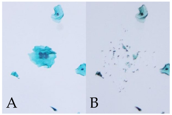 Profiles of Human Papillomavirus Detection of the Multinucleated Cells ...