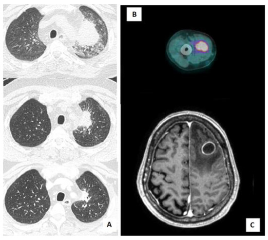 Nocardia Infections in the Immunocompromised Host: A Case Series and ...