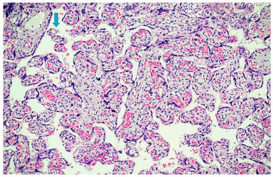 Congenital Syphilis Presenting with Brain Abnormalities at Neuroscan: A ...
