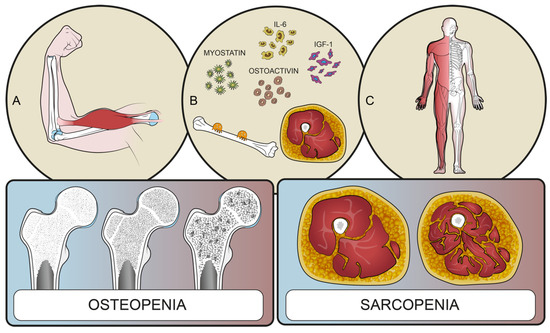 Osteopenia and Sarcopenia as Potential Risk Factors for Surgical Site Infection after Posterior ...