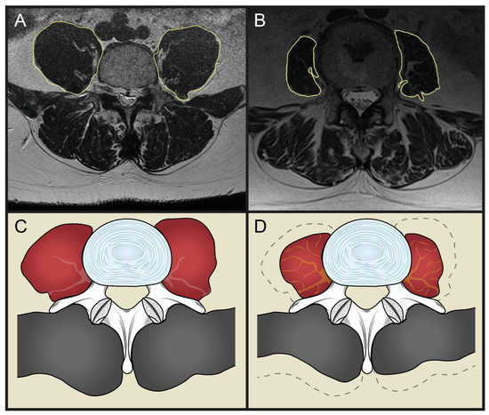Osteopenia and Sarcopenia as Potential Risk Factors for Surgical Site Infection after Posterior ...