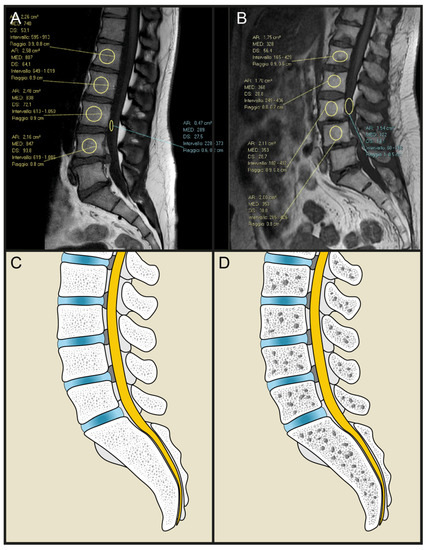 Osteopenia and Sarcopenia as Potential Risk Factors for Surgical Site Infection after Posterior ...