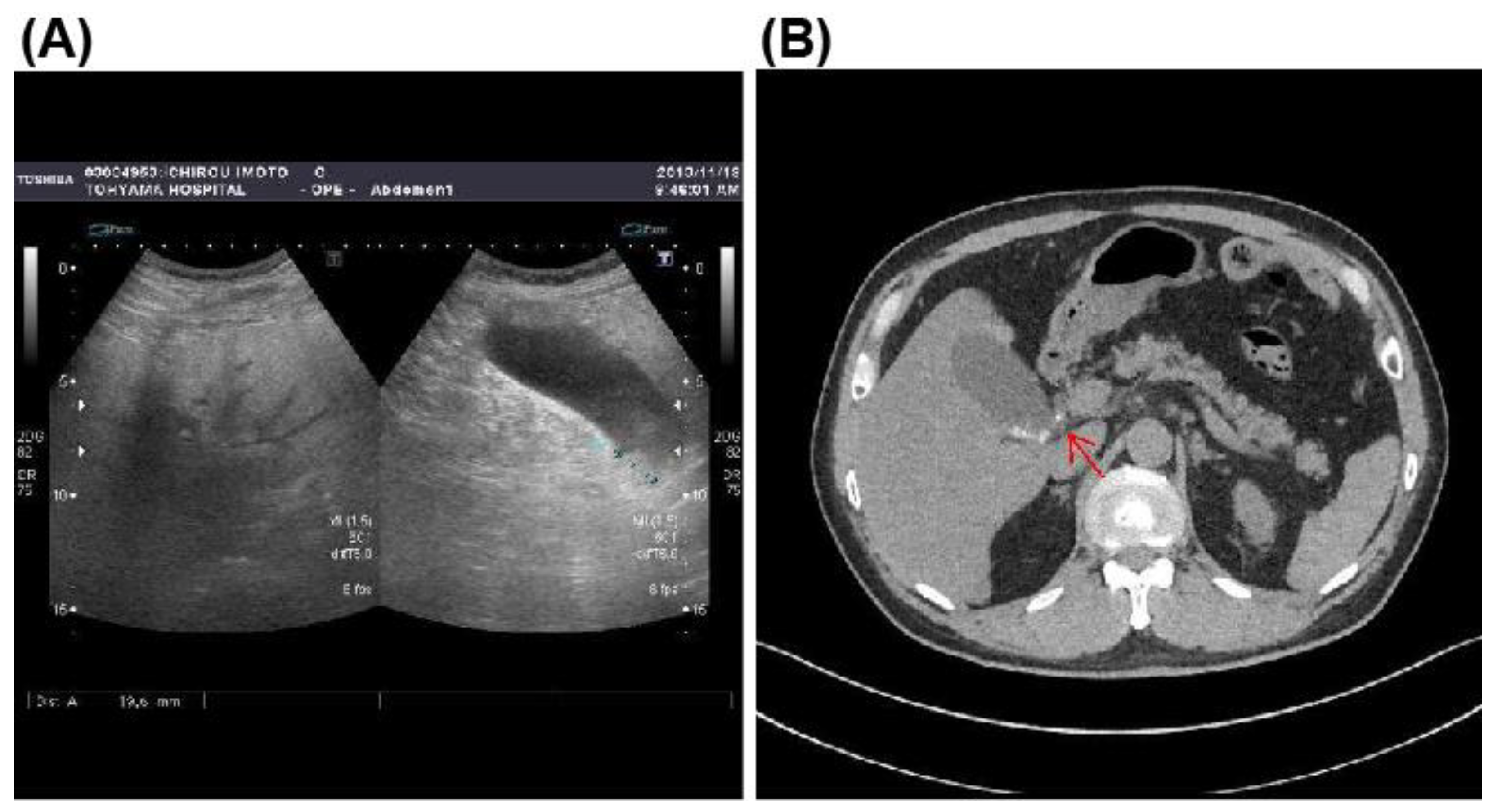 Acute Calculous Cholecystitis Caused by Streptococcus gallolyticus subspecies pasteurianus: A ...