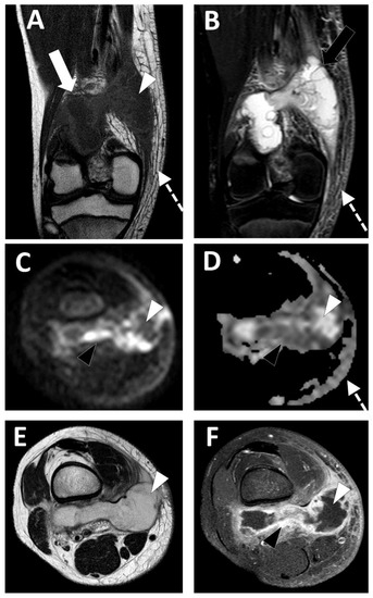 Imaging of Musculoskeletal Soft-Tissue Infections in Clinical Practice ...