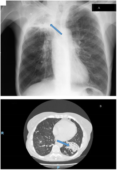 Updated Review on the Mechanisms of Pathogenicity in Mycobacterium ...